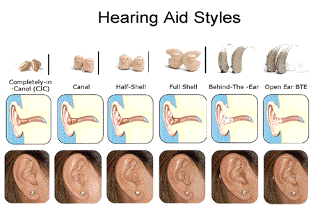 What are the different types of hearing loss?